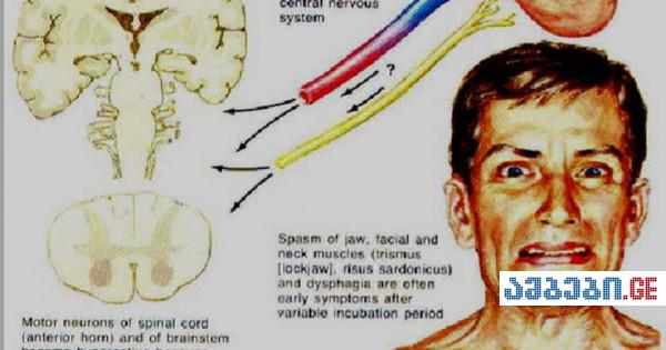 სიმპტომები და ბრძოლის გზები - რა უნდა ვიცოდეთ ტეტანუსის შესახებ | Ambebi.GE